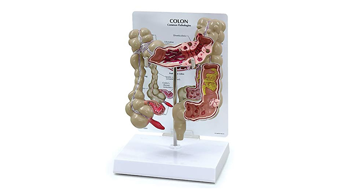 Colon Model for Patient Education - GPI Anatomicals