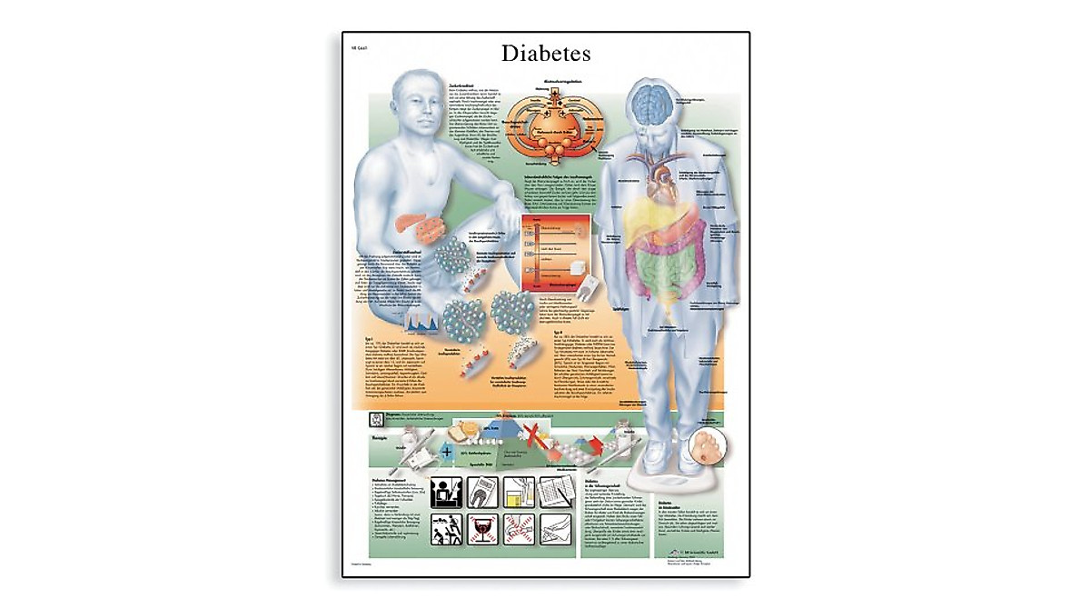 Diabetes Anatomical Chart - 3B Scientific Poster