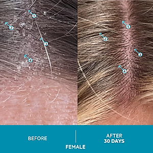 DS Laboratories Dandrene Anti Dandruff Shampoo - Exfoliating Shampoo for Dry Itchy Scalp, Dandruff Scalp Treatment, Seborrheic Dermatitis & Psoriasis