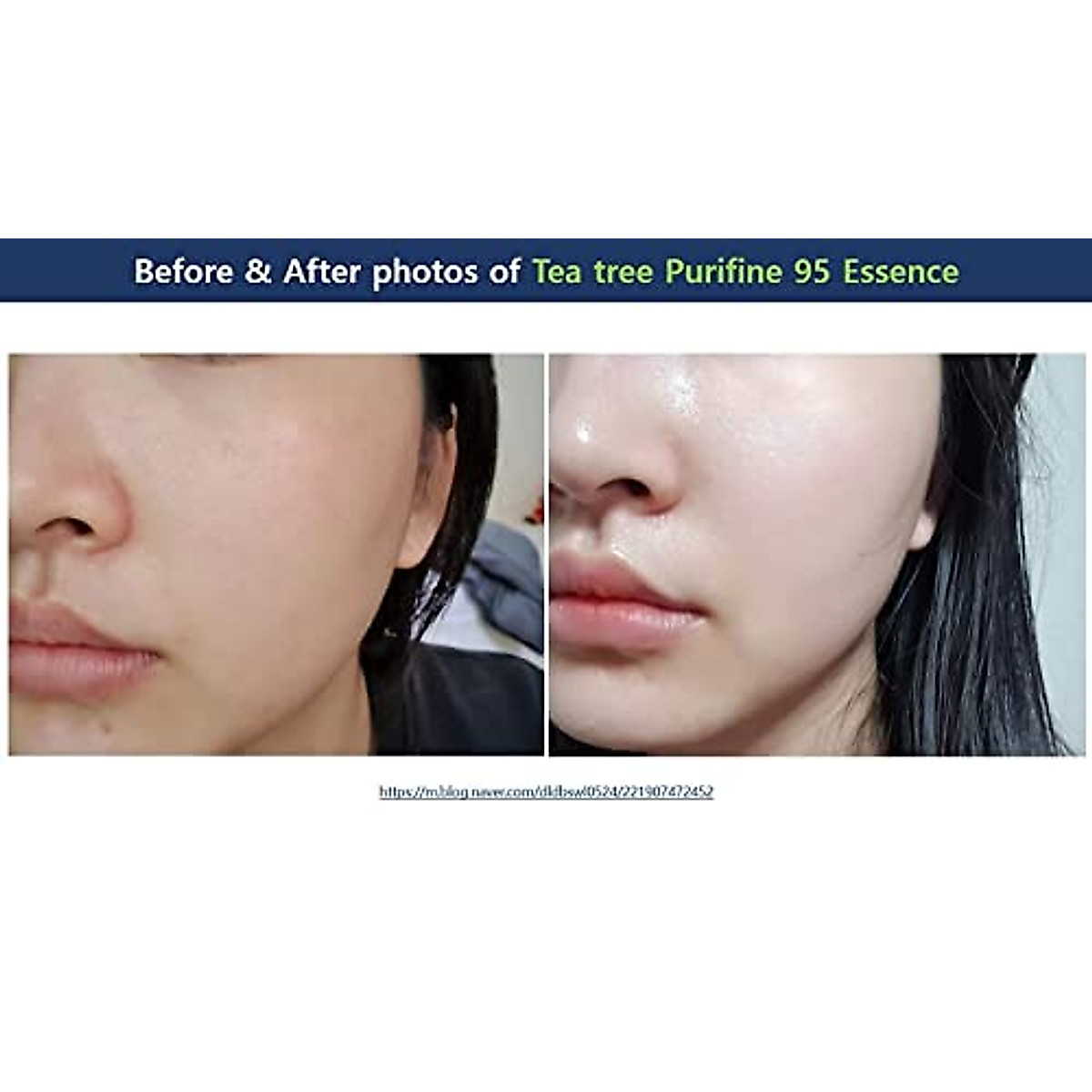 Dr.Ceuracle Tea Tree Purifine EssenceㅣThe Mildest Serum with 95% Tea Tree Extract ㅣLightweight Moisturizer for Returning Skin's Natural Vitality, ComplexionㅣIntensive Care for Calming Skin Trouble, Acne