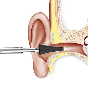 Teslong Otoscope Accessories: 9 Disposable Speculums, 4 Ear Picks, 1 Pack of Q-Tips, Accessories for NTE100i Ear Camera Ear Scope, 0.16 inch or 4.3mm Dia.