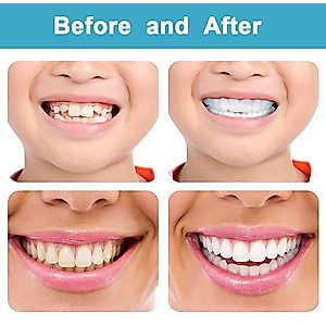 Top and Bottom Fake Teeth Cover the Broken and Missing Tooth Snap on Instant & Confidence Smile