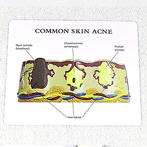 DABAUR Organ Model Skin Hair Follicle Hair Acne Pustule Blackhead Anatomical Model for Study Display Teaching Anatomical Model