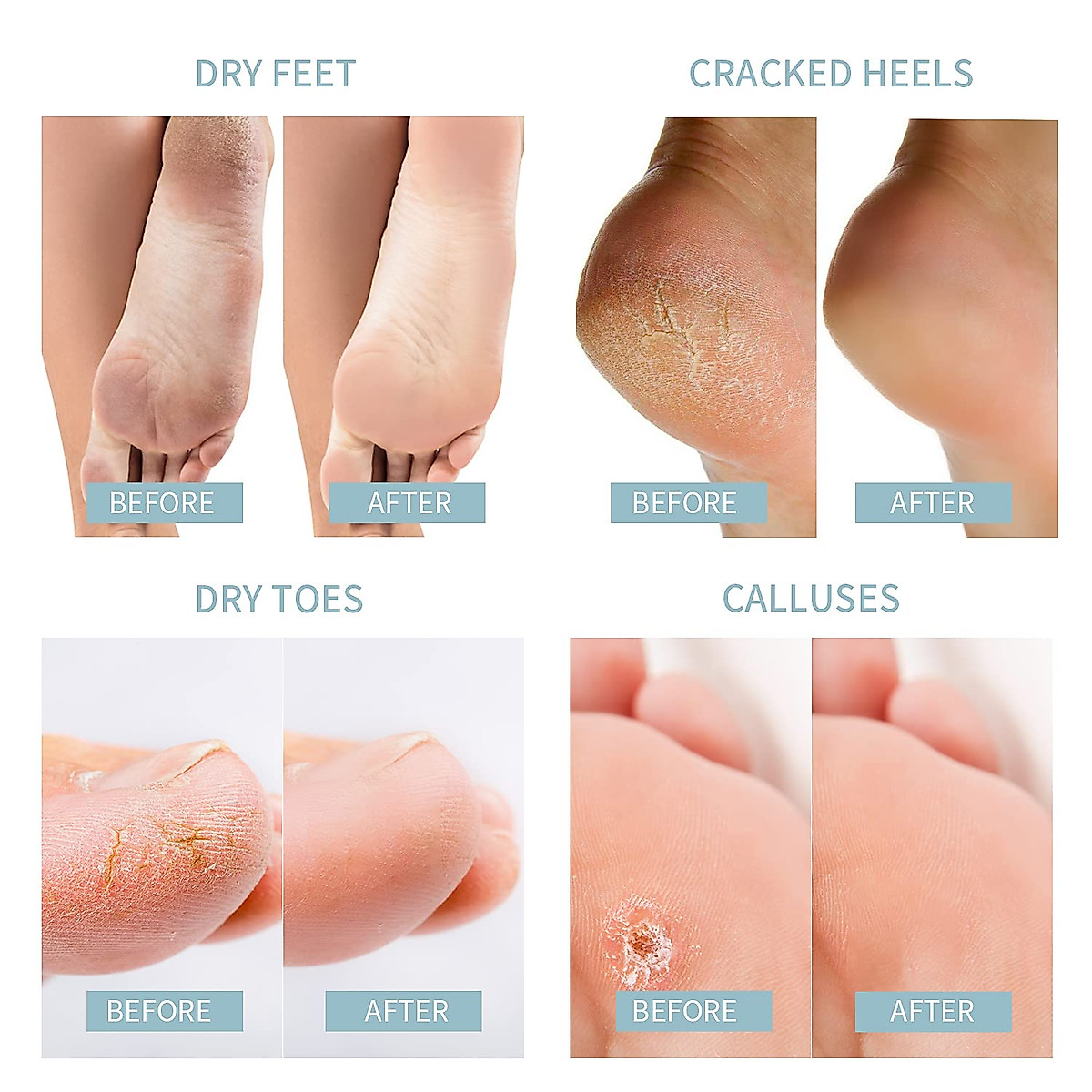 Foot Masks-5 Pack,Natural Foot Care Exfoliating Treatment Repairs Cracked Heels,Peeling Away Calluses and Dead Skin Cells,Make Your Feet Baby Soft & Get a Smooth Skin -For Men Women（Milk &Avocado）