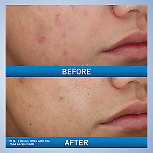 CeraVe Acne Foaming Cream Wash, Gentle Face and Body Cleanser with Benzoyl Peroxide 10%, Hyaluronic Acid, and Niacinamide, 10% Benzoyl Peroxide Treatment Clears Pimples and Blackheads 5 Oz