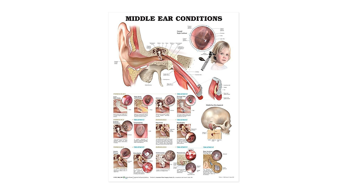 Middle Ear Conditions Anatomical Chart | Comprehensive Otology Guide