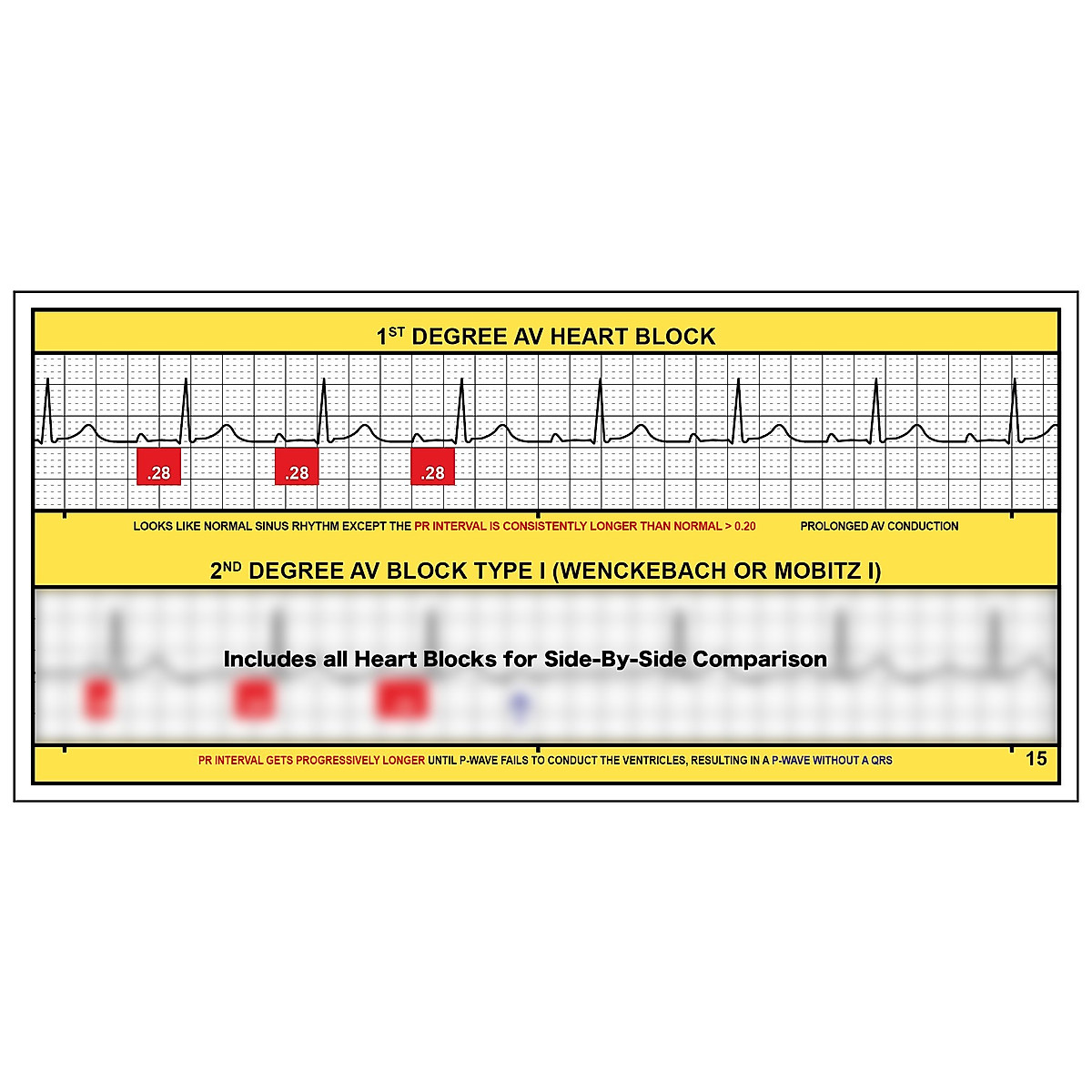 R-CAT for Arrhythmias EKG Pocket Reference Guide – Great Study Card for EKG Interpretation - ACLS and PALS Training – Cardiac Rhythm Interpretation Made Easy