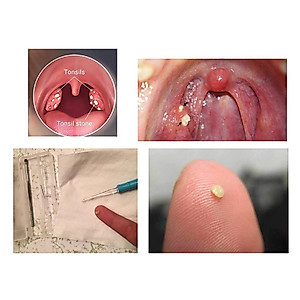 Airgoesin 2 Lighted Tonsil Stone Remove Tool, 10 Tips, Tonsillolith Pick + Case Oral Clean Longer Attachment