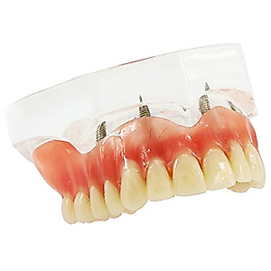 DENTALMALL Dental Upper Implants Model Overdenture with 4 Superior Teeth Demo Transparent Vision for Education and Study Model Tool M6001 C