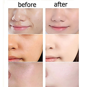 Hilos Tensores Para El Rostro, Hilos de Colageno Absorbibles para la Cara, Acido Hialuronico Puro Para Rostro, Proform Korean Soluble Protein Thread, Face Serum for Lift