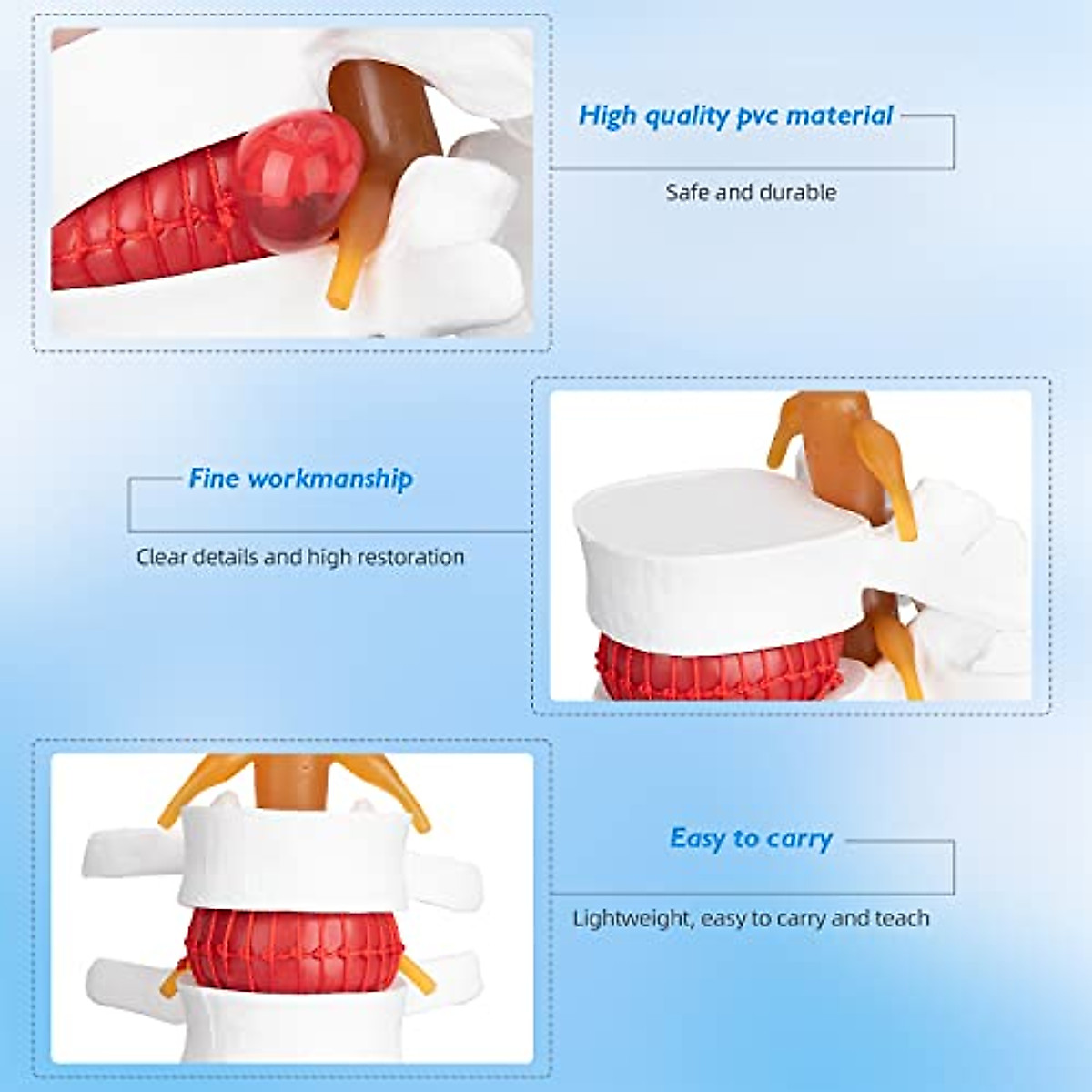 faruijie Disc Herniation Model - 1.5X Lumbar Herniated Disc Model Vertebral Spine Anatomical Medical Model