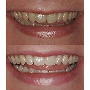 ProDental Teeth Whitening Gel Syringe Refill 10 Pack, 35% Carbamide Peroxide - 60 Treatments, Faster Results Than Tooth Whitening Strips - Pen - Powders and Toothpaste, Safe for Sensitive Teeth