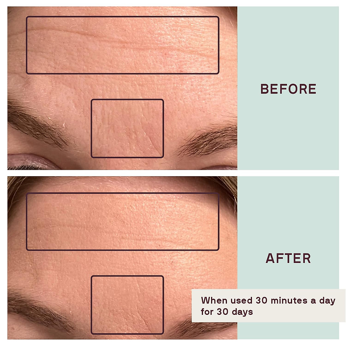 Dermaclara Silicone Facial Patches - Anti-Wrinkle Face Patches for Frown, Smile Lines & Forehead, Reusable Overnight Silicone Wrinkle Pads, Up to 30 Uses - 4 Under Eye Patches & 1 Forehead Patch