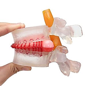 MIIRR Human Lumbar Disc Herniation Model, Transparent Medical Model of Vertebral Spine Anatomy with Elastic Software, Perfect for Learning and Teaching Tool