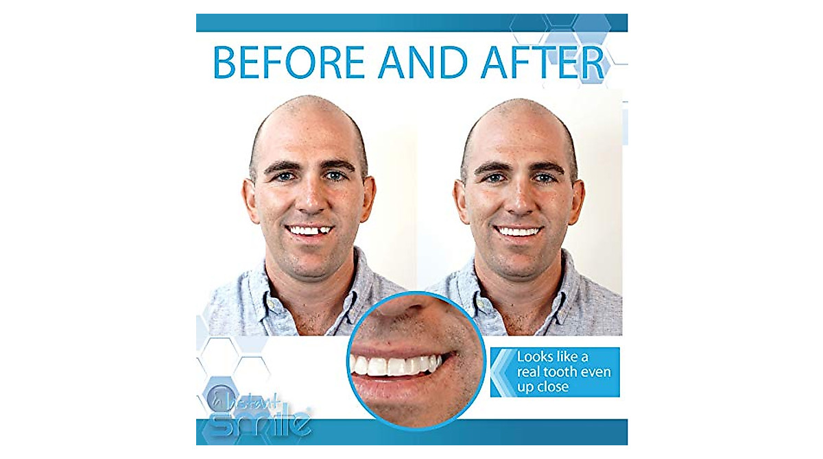 Instant Smile Complete Tooth Replacement Kit | Fast & Natural Look