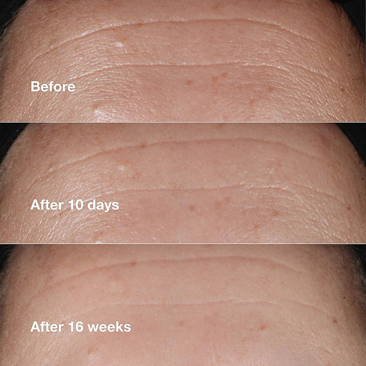 Clinique Smart Clinical Repair Wrinkle Correcting Face Serum With Hyaluronic Acid, Peptides + Advanced Retinoid Serum | Anti-Aging + Hydrating, 3.4 Fl Oz