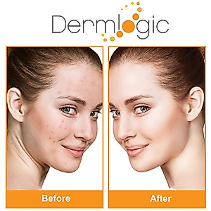 Acne Treatment Pads- Contains Salicylic, Glycolic, & Lactic Acid for Face & Body. Clears Away Clogged Pores, Oily Skin & Cystic Breakouts. Removes Dark Spots, Blackhead & Whitehead Pimples