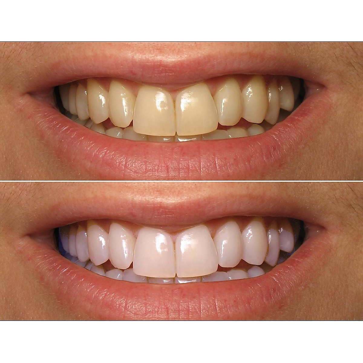 ProDental Teeth Whitening Gel Syringe Refill 10 Pack, 35% Carbamide Peroxide - 60 Treatments, Faster Results Than Tooth Whitening Strips - Pen - Powders and Toothpaste, Safe for Sensitive Teeth