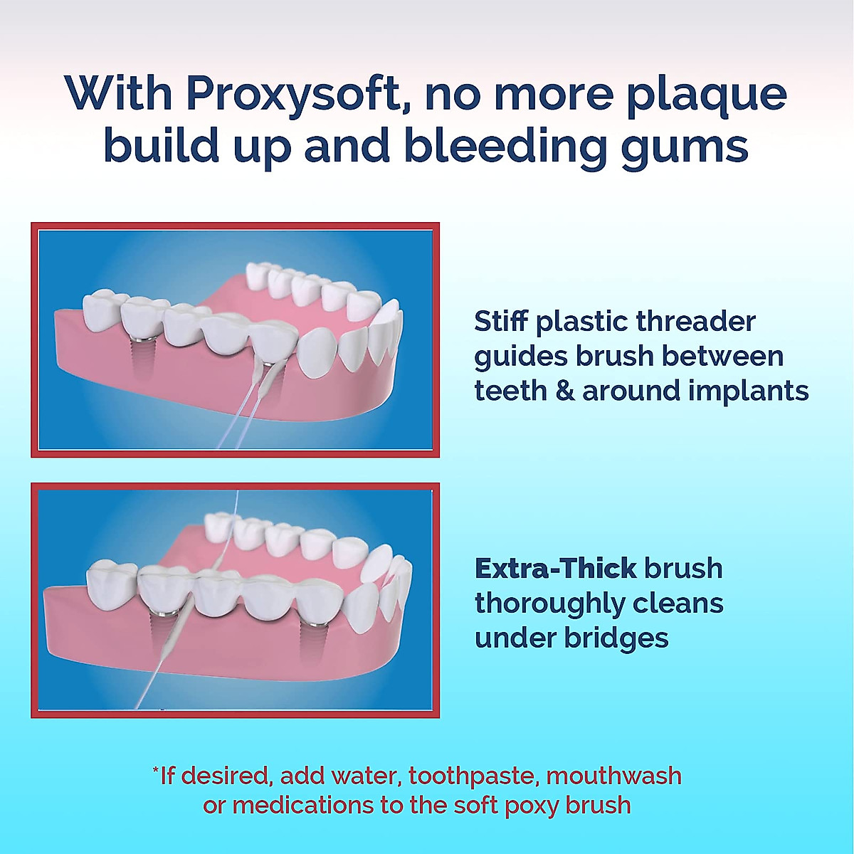 Proxysoft Dental Floss for Bridges and Implants 5 Packs - Floss Threaders for Bridges, Dental Implants, Braces with Extra-Thick Proxy Brush for Optimal Oral Hygiene -Teeth Bridge and Implant Cleaners