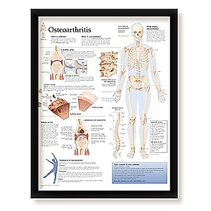 Set of 3 Framed Medical Posters Osteoarthritis Rheumatoid Arthritis Understanding Osteoporosis 22"x28" Wall Diagrams Educational Informational Doctors Office Rheumatology Charts