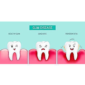 Perio Restore® Gel 3 Ounce Tube; 1.7% Hydrogen Peroxide Oral Cleansing Treatment; Oral Cleansing Gel. Includes Two (2) Trays for Ease of Application. Mint Flavor, at-Home Treatment