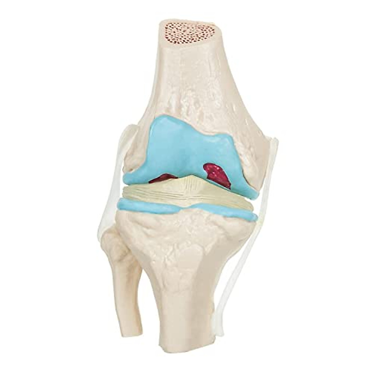 Spancare 4 Stage Osteoarthritis Anatomical Knee Model, Model On Base, with Detailed Study