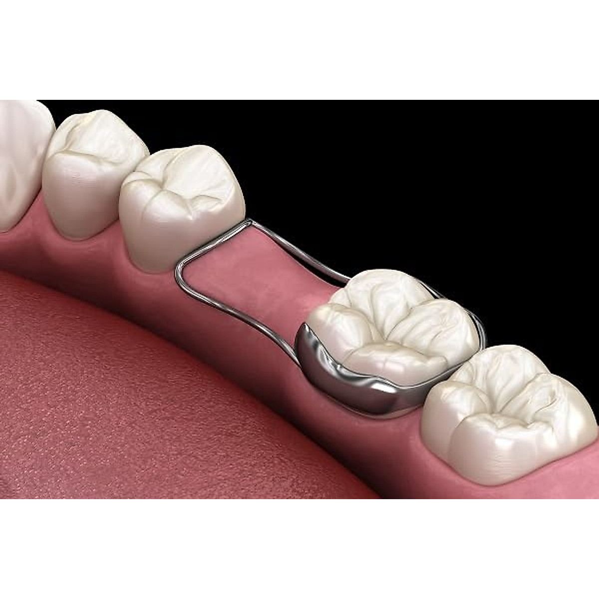 Space Maintainer For Children,10 Size/Box, 40pcs/Box, 4pcs/Size From Sino Dental Group (#6 Molar)