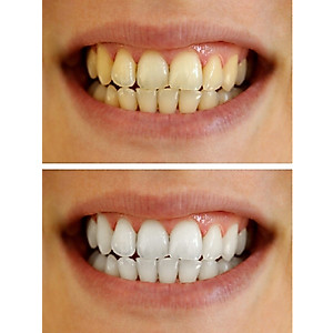 Teeth Whitening Gel 10% Carbamide Peroxide Tooth Bleaching Dispensers 10 pcs