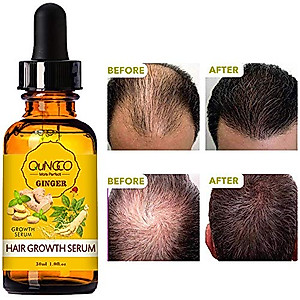 5 PACK Hair Growth Serum Liquid Hair Loss Treatment for Women & Men Dense Thicken Hair