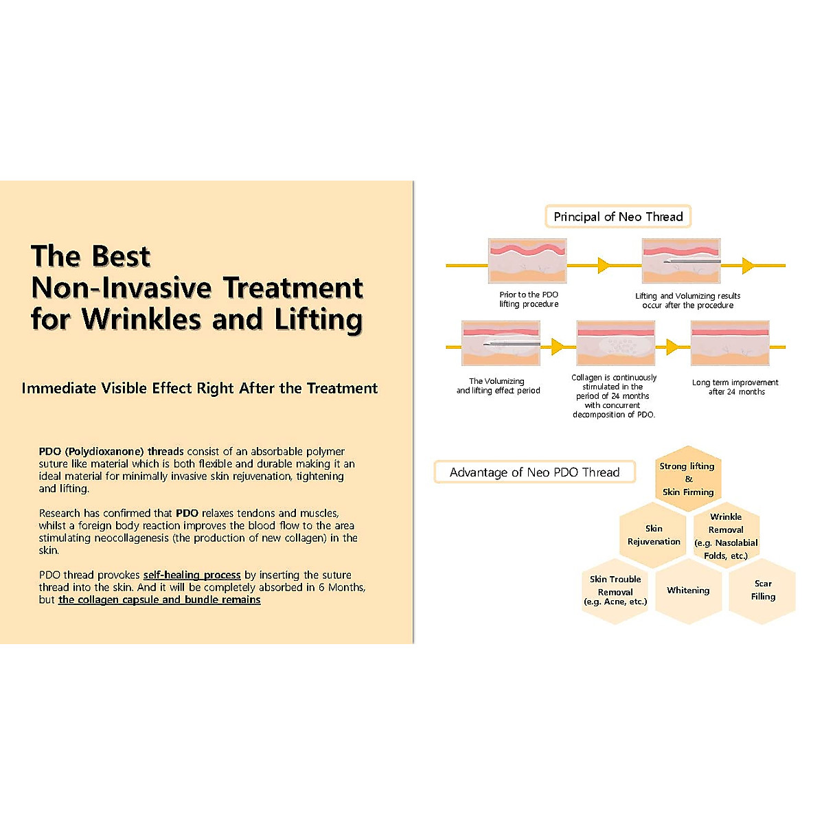 NeoGenesis PDO Mono Threads for Face and Body Lift 20PCS (31G X 12mm) (M3112)
