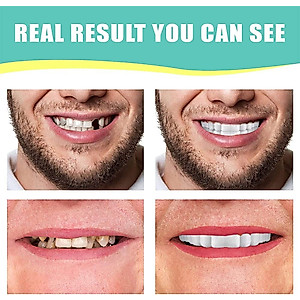 1Set Dentures Veneers Tooth,Dental Care Kits for Anti Molar Orthodontic Cosmetic Teeth,Smile Snap Tooth.(White,1Top+ 1Bottom+2Adhesives+1Tweezers+1Heart-Shaped Storage Box）