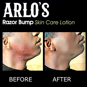 Arlo's Razor Bump Skin Care Lotion 6 oz.