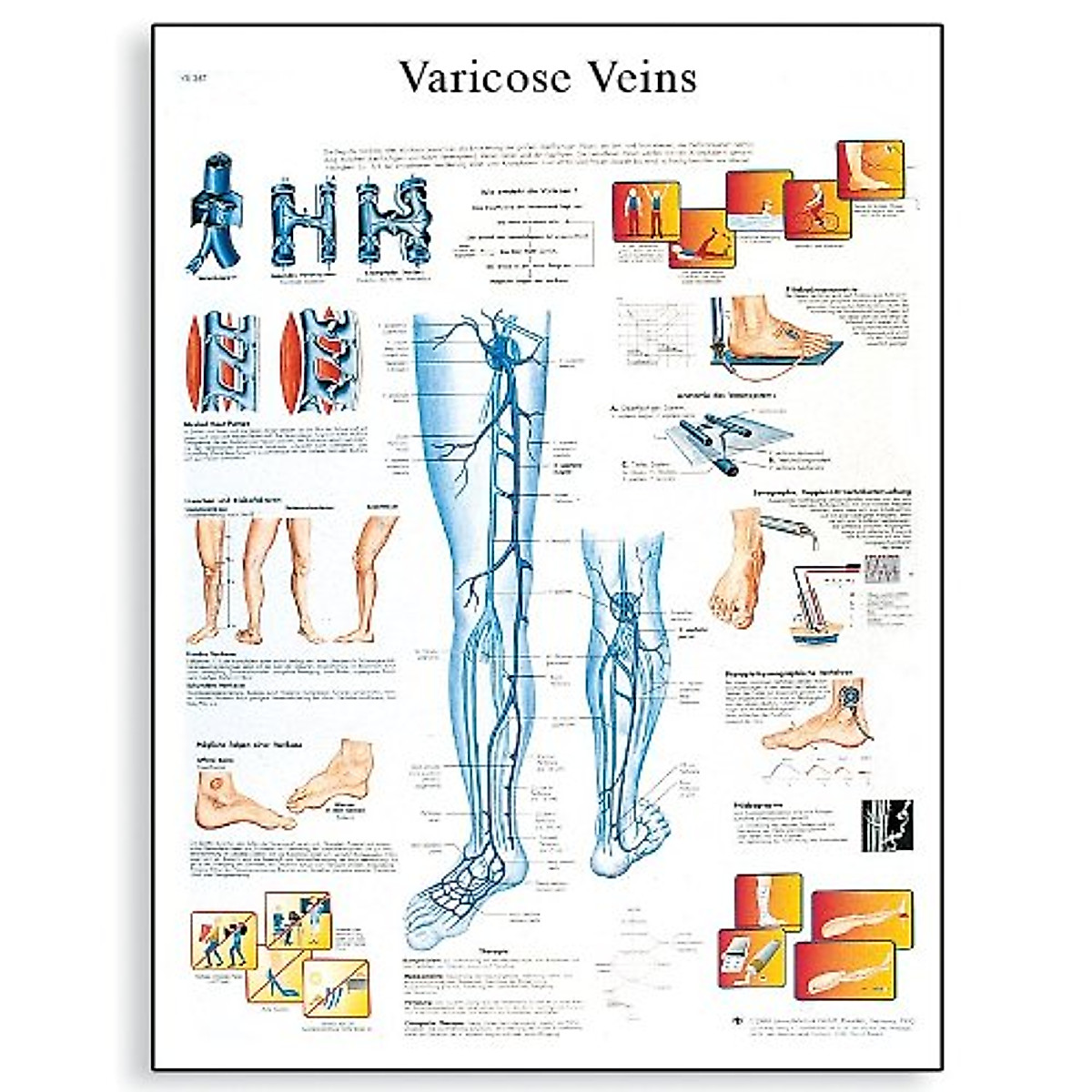 3B Scientific VR3367L Glossy UV Resistant Laminated Paper Afeccion Por Varices, Varicosidades Anatomical (Varicose Veins Anatomical Chart,Spanish), Poster Size 20" Width x 26" Height, Yellow
