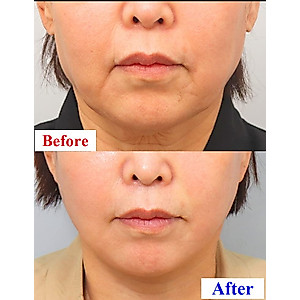 WHITESILK(𝟐𝟎𝟐𝟒 𝐔𝐩𝐠𝐫𝐚𝐝𝐞𝐝) Anti-Aging Skin Boosting SCM75 + HGF (Advanced +) Human Stem Cell 750,000ppm Super Ampoule, with SCM-3D Biomimetic Technology (10ml x 5 vials, 1.69oz)