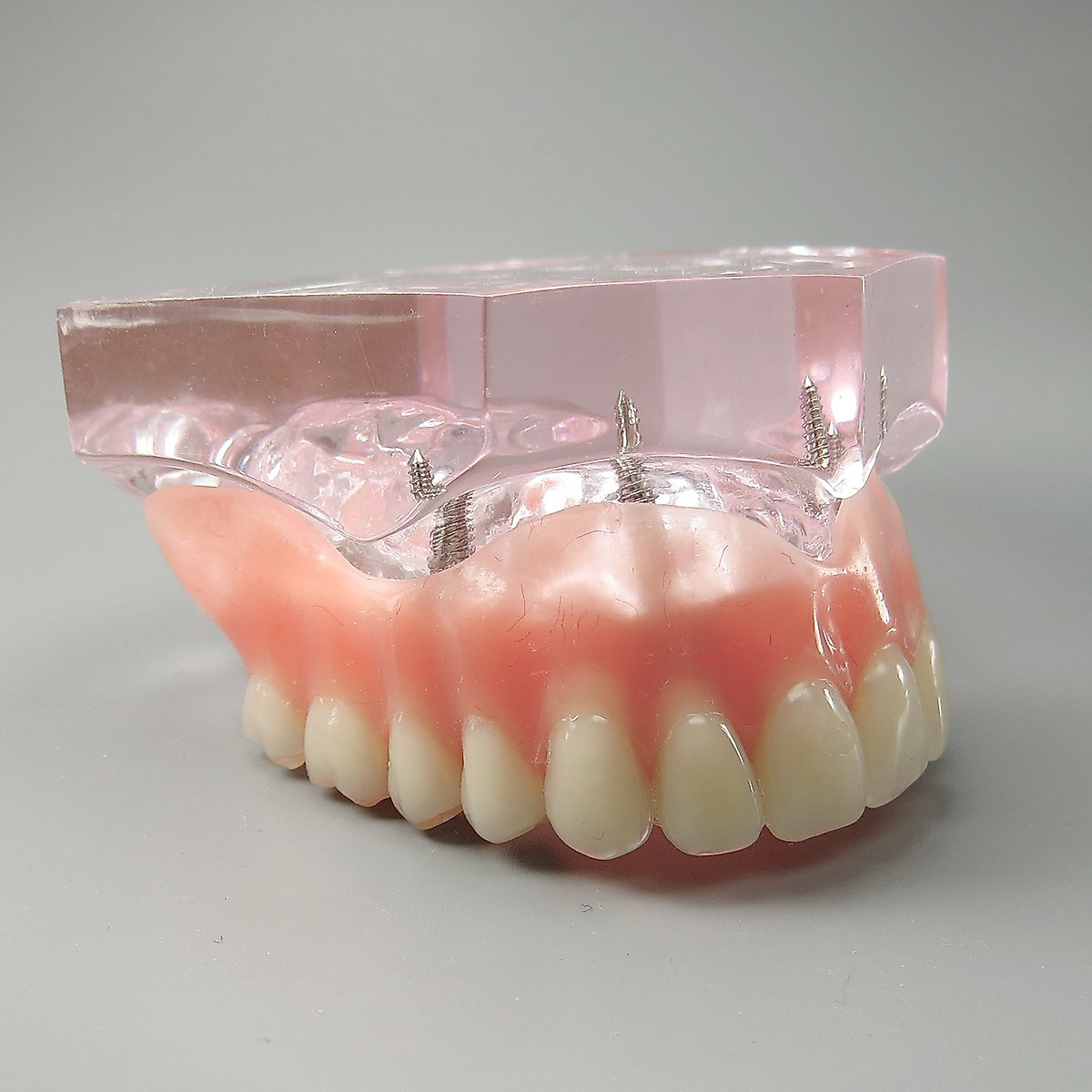 Dental Model Overdenture Upper Teeth 4 Implants Demo for Teaching and Studying