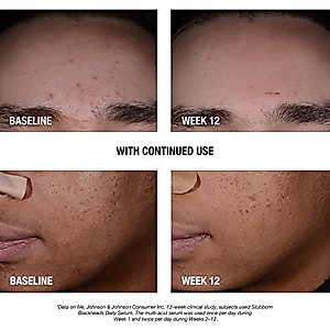 Neutrogena Stubborn Blackheads Daily Acne Facial Serum with Salicylic, Glycolic, Polyhydroxy & Mandelic Acids, Oil-Free Face Serum for Acne-Prone Skin to Help Clear Clogged Pores, 1 fl. oz