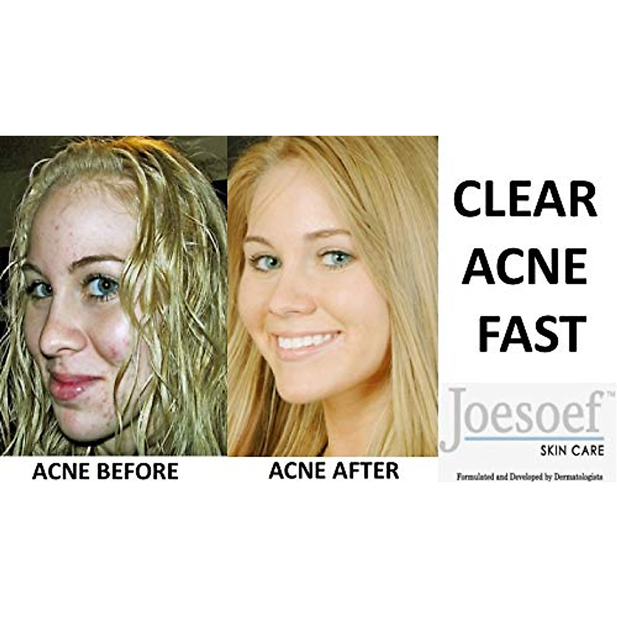 JOESOEF SKIN CARE Sulfur Soap for Acne Pharmaceutical Grade Dermatologists Approved for Acne Rosacea 100G