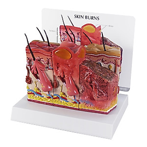 Skin Burn Model | Human Body Anatomy Replica of Varying Degrees of Skin Burn for Dermatology Educational Tool | GPI Anatomicals