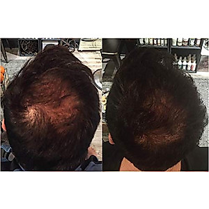 Zenagen Revolve Thickening Hair Loss Treatment for Men, 6.75 Fl Oz