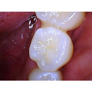 TELICAM Intraoral Camera Dental, Works with Eaglesoft, Dexis, Apeteryx, Carestream, Tigerview