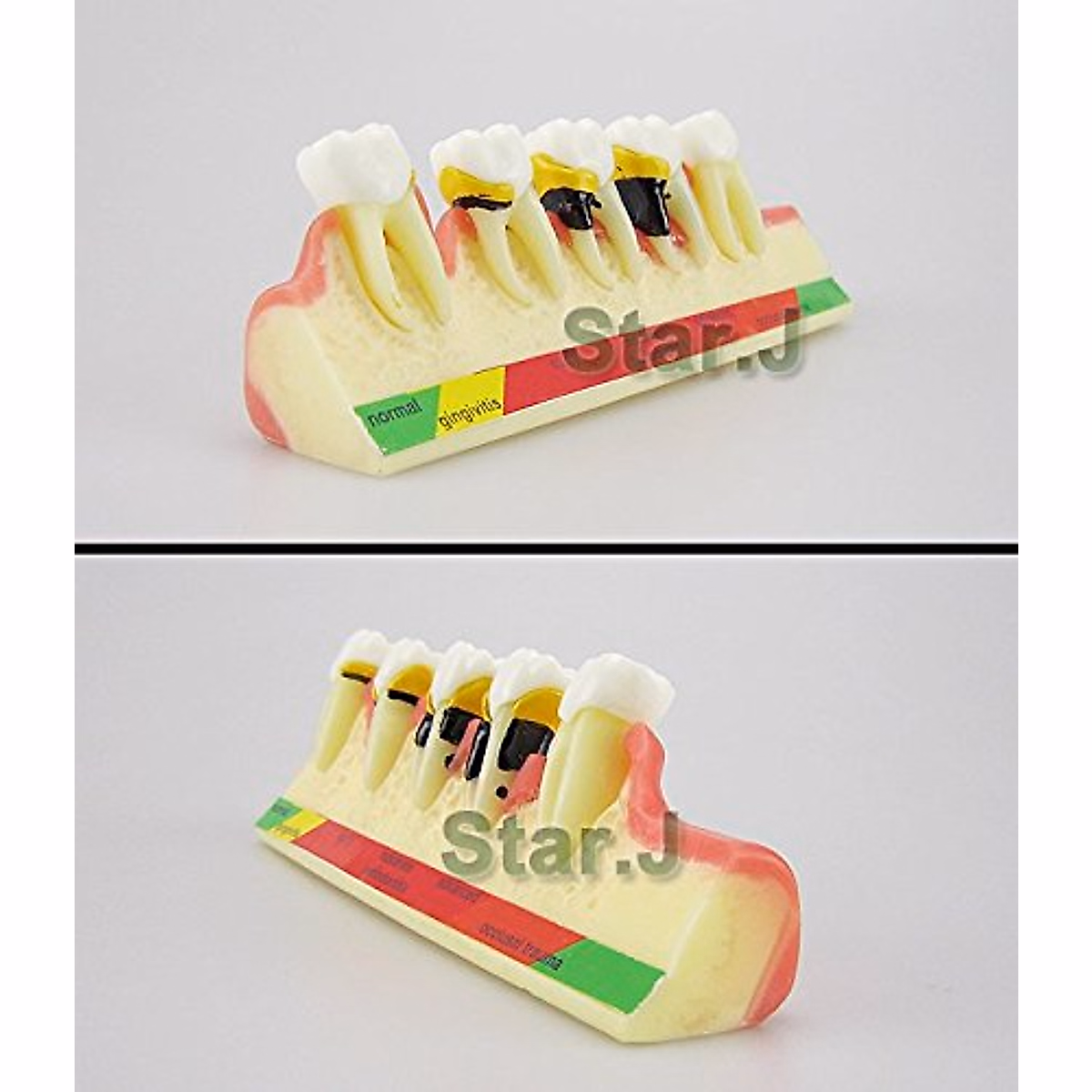 Dental Periodontal Disease assort Tooth Teeth Typodont Study Teaching Model New