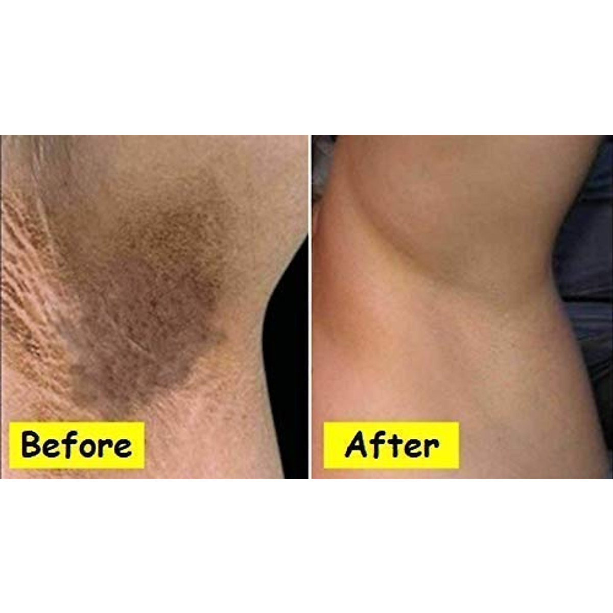 TOWELL Crema Aclaradora Para Piel Manchas En Cara Axilas Cuello Entrepierna