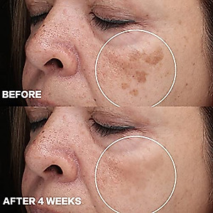 CITYGOO Dark Spot Remover for Face and Body, Dark Spot Corrector Cream, Natural Ingredient,Enriching Skin Care For All Skin Tones - Melasma, Freckle, Sun Spot Remover & Blemish Reducer-1.7 FL OZ