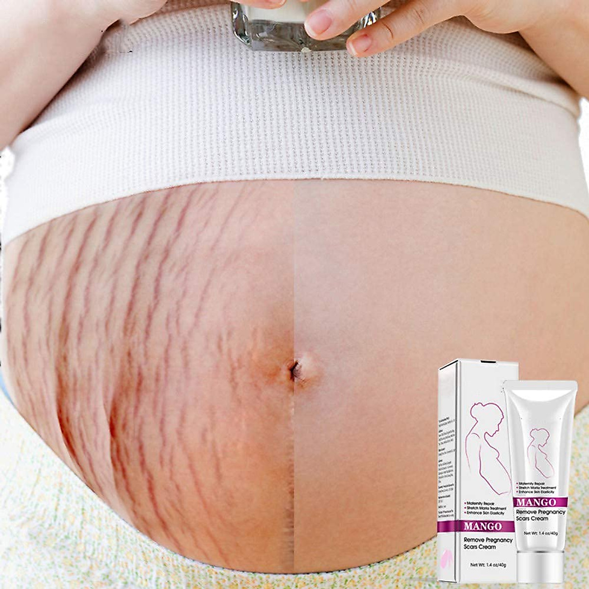 Stretch Mark Cream For Pregnancy Repair Scar Slack Line Abdomen Stretch Marks Cream, Remove Stretch Marks From Pregnancy, Repair Scar Slack Line Abdomen Stretch Marks Postpartum
