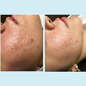 Salicylic Gel Chemical Peel - Enhanced with Green Tea Extract and Tea Tree Oil (20% Strength)