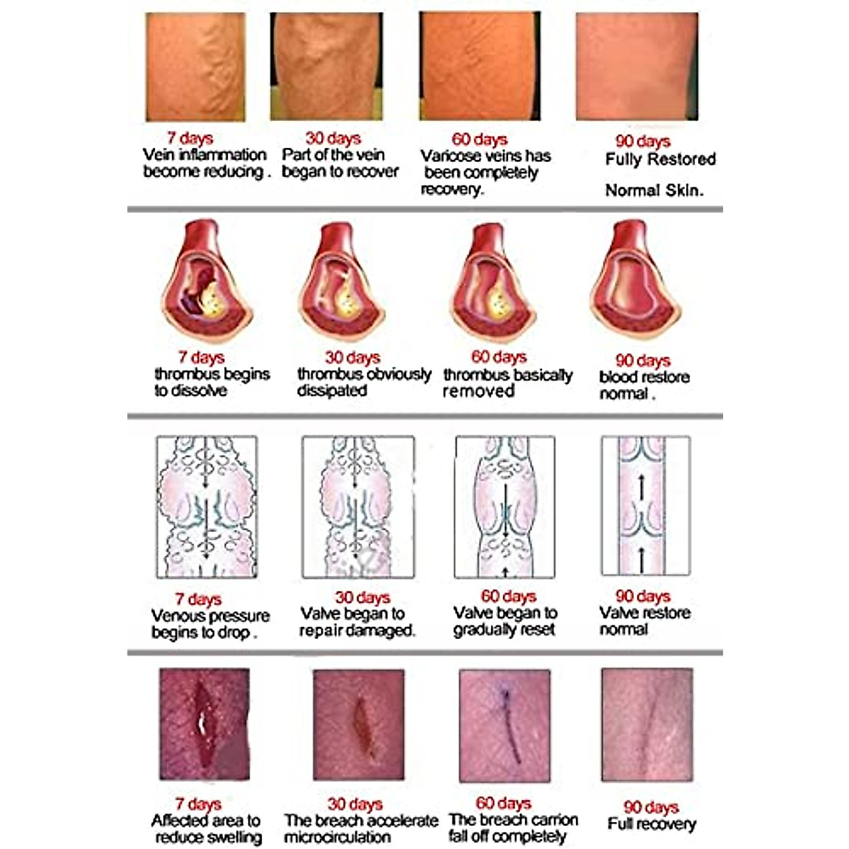 LBXB 1/2/3pcs Advanced Varicose Remission Cream Ointment, Spider Leg Repair Cream, Varicose Veins Cream, Varicose Vein & Soothing Leg Chinese Treatment Cream Miracle Relief Phlebitis Angiitis (3pcs)