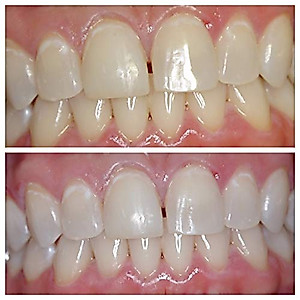 Ultra White 22% Teeth Whitening Gel Large 5 Tubes 3.8 ml of Gel use for Beautiful White Smile