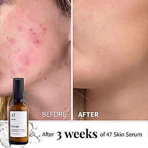 47 Skin Hydrating Face Serum for Clearing Acne & Scars, Anti-Blemish & Scar Repair Serum Skincare Treatment with Silver Chitoderm - Smooth Skin Moisturiser Facecare Serum for All Skin Types (1.01 oz)