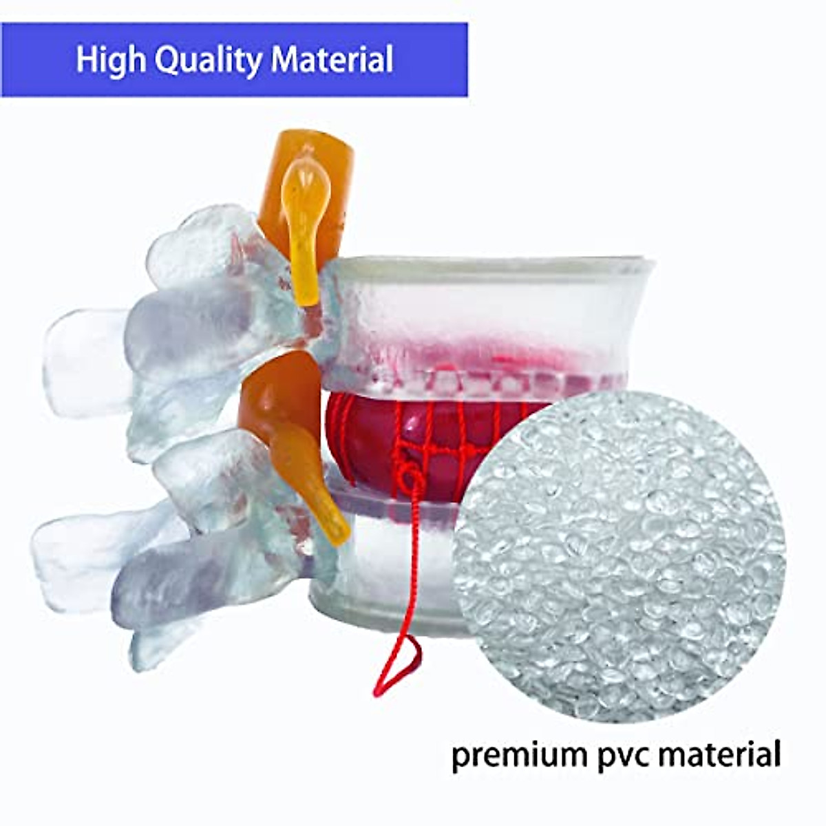 Veipho Human Anatomical Lumbar Disc Herniation Model, Transparency Lumbar Disc Herniation Model, Lumbar Disc Model for Teaching and Demonstrating