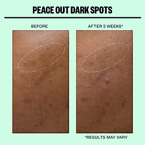 Peace Out Skincare Dark Spots. Dissolving Microstructure Dots to Reduce the Appearance of Dark Spots & Hyperpigmentation, Niacinamide Helps Reveal Clear, Even Skin (12 dots)